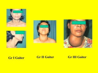 Grading of Size of Clinical Goiter | PPT