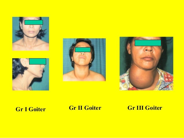 Grading of Size of Clinical Goiter