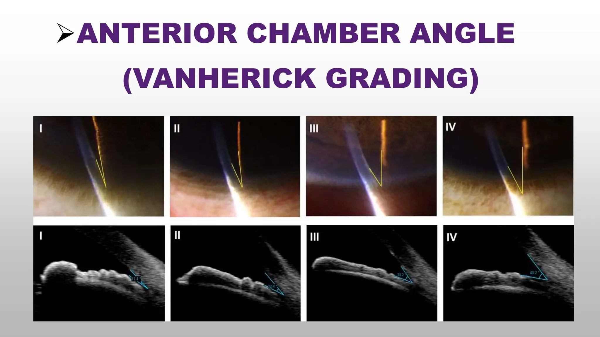 Grading of anterior segment.pptx