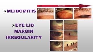 Grading of anterior segment.pptx