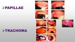 Grading of anterior segment.pptx