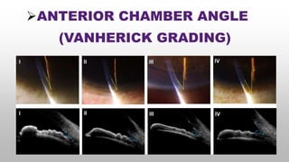 Grading of anterior segment.pptx