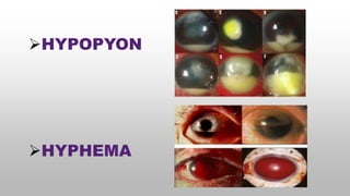 Grading of anterior segment.pptx