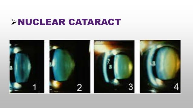 Grading Of Anterior Segment Pptx