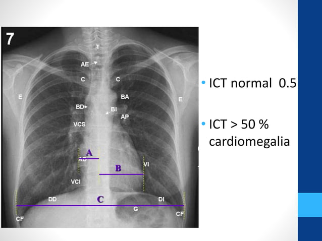Grados-de-Cardiomegalia-de-Acuerdo-al-ICT.pptx