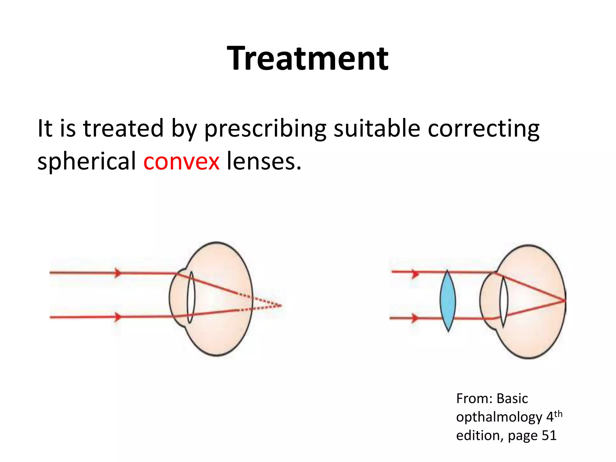 Gradual loss of vision (opthalmology) | PPTX