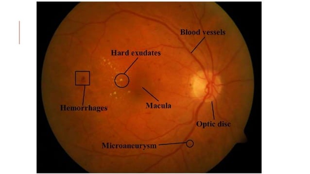 Gradual vision loss | PPTX