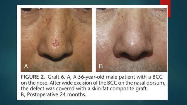 Skin-Fat Composite Grafts for Reconstructing Large Full-Thickness Skin ...