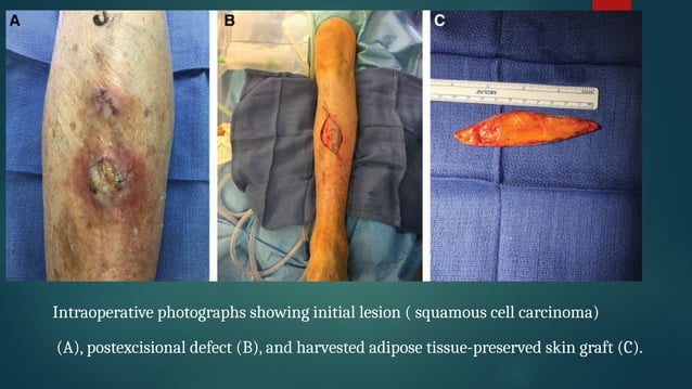 Skin-Fat Composite Grafts for Reconstructing Large Full-Thickness Skin ...