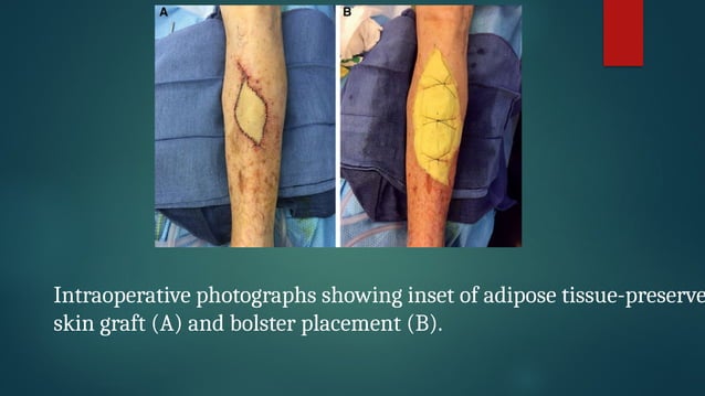 Skin-Fat Composite Grafts for Reconstructing Large Full-Thickness Skin ...
