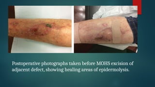Skin-Fat Composite Grafts for Reconstructing Large Full-Thickness Skin ...
