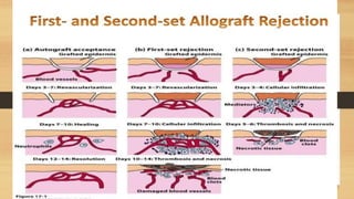 types of graft rejection seminar skin rejection | PPTX