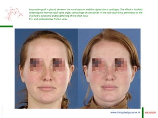 Grafts in nasal surgery | PPTX