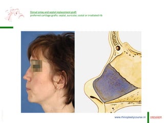 Grafts in nasal surgery | PPTX