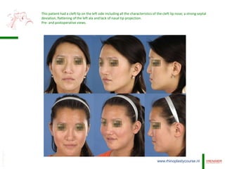 Grafts in nasal surgery | PPTX