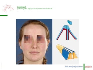 Grafts in nasal surgery | PPTX