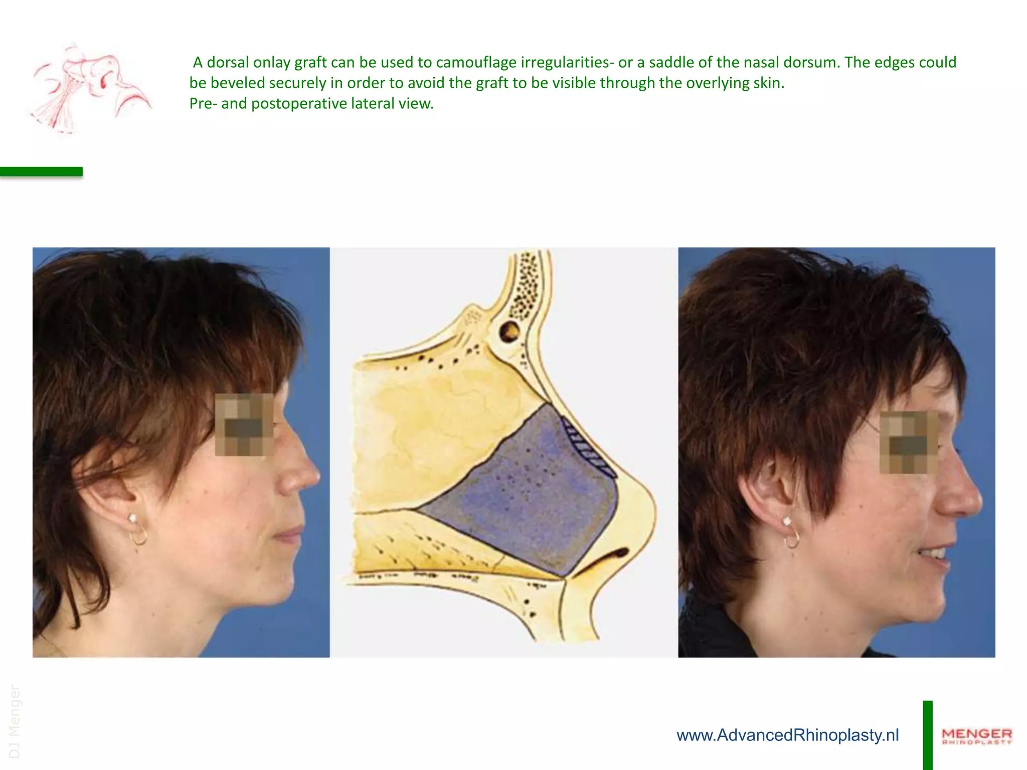 Grafts in Nasal Surgery - Advanced Rhinoplasty | PPTX
