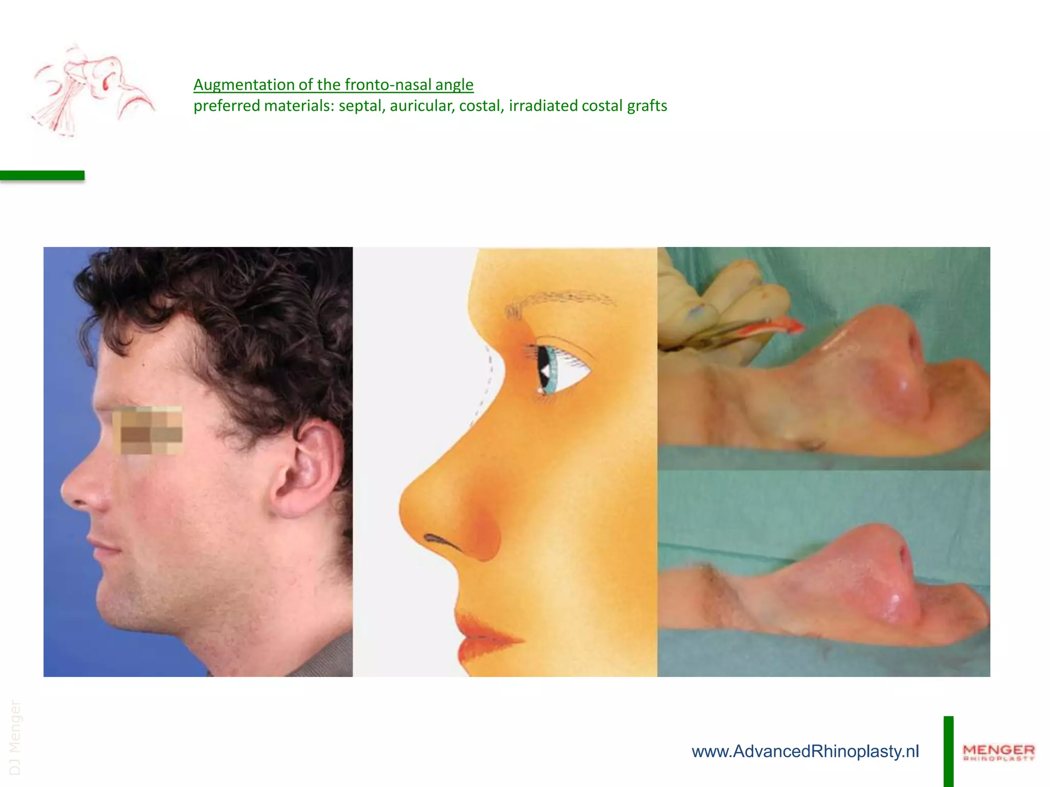 Grafts in Nasal Surgery - Advanced Rhinoplasty | PPTX
