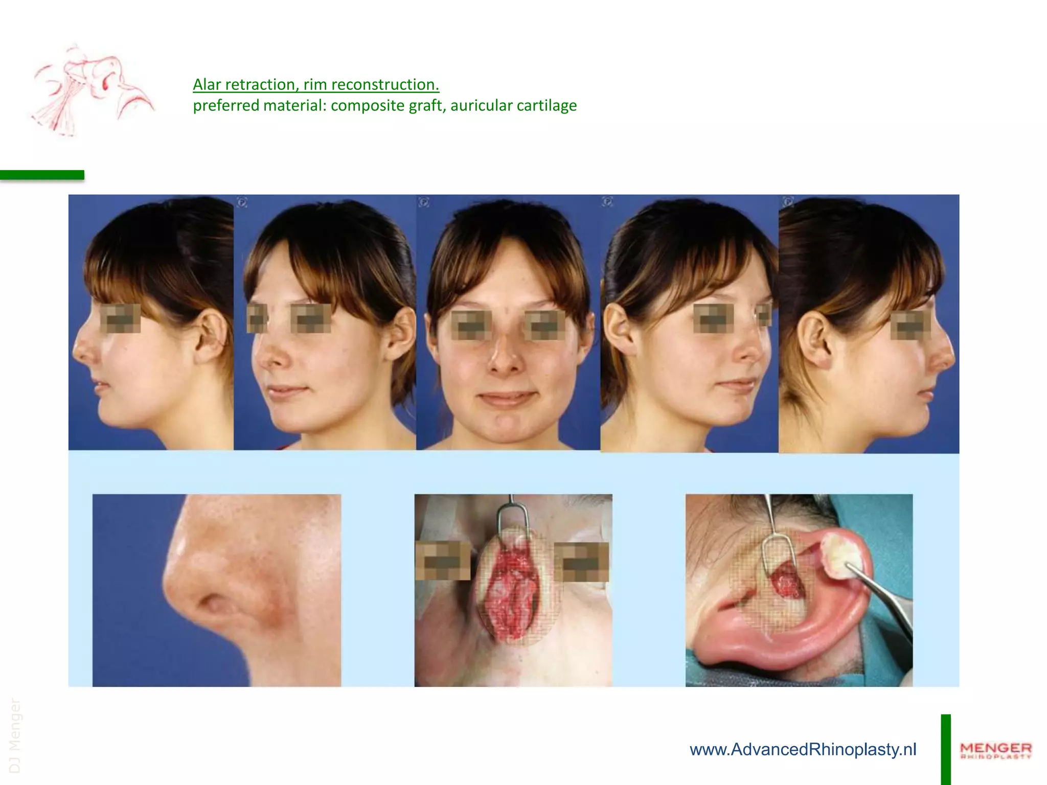Grafts in Nasal Surgery - Advanced Rhinoplasty | PPTX
