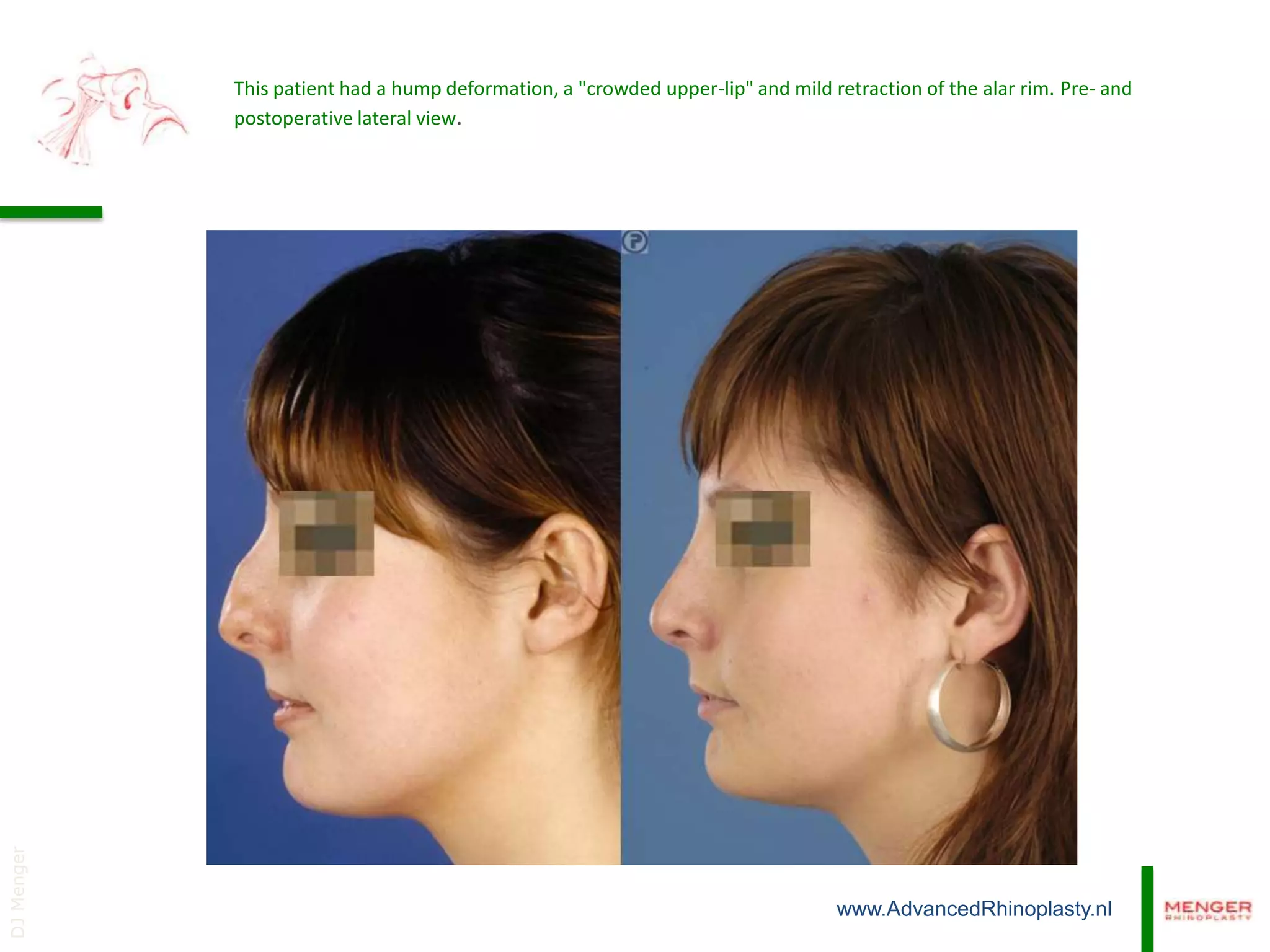 Grafts in Nasal Surgery - Advanced Rhinoplasty | PPTX