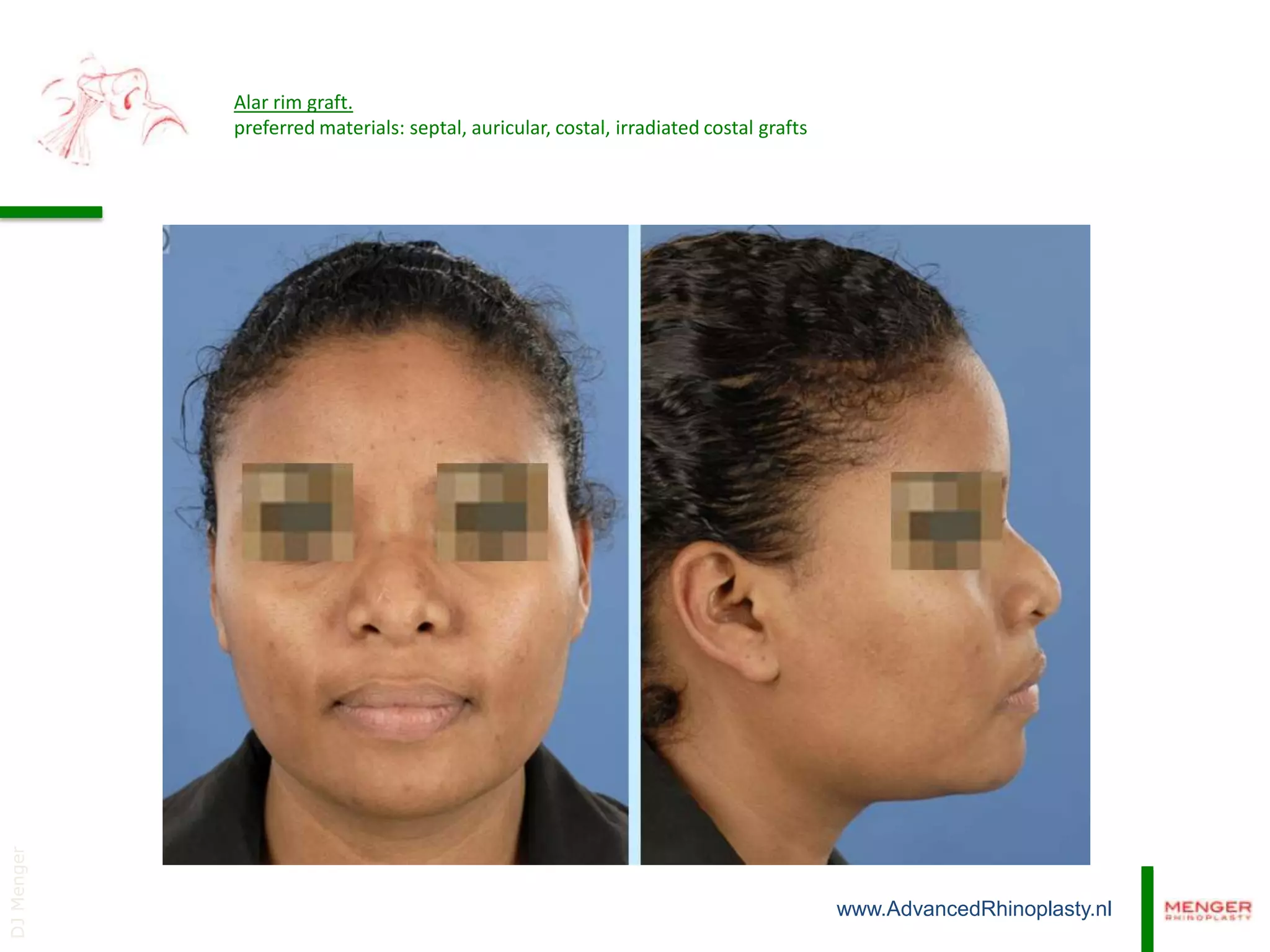Grafts in Nasal Surgery - Advanced Rhinoplasty | PPTX