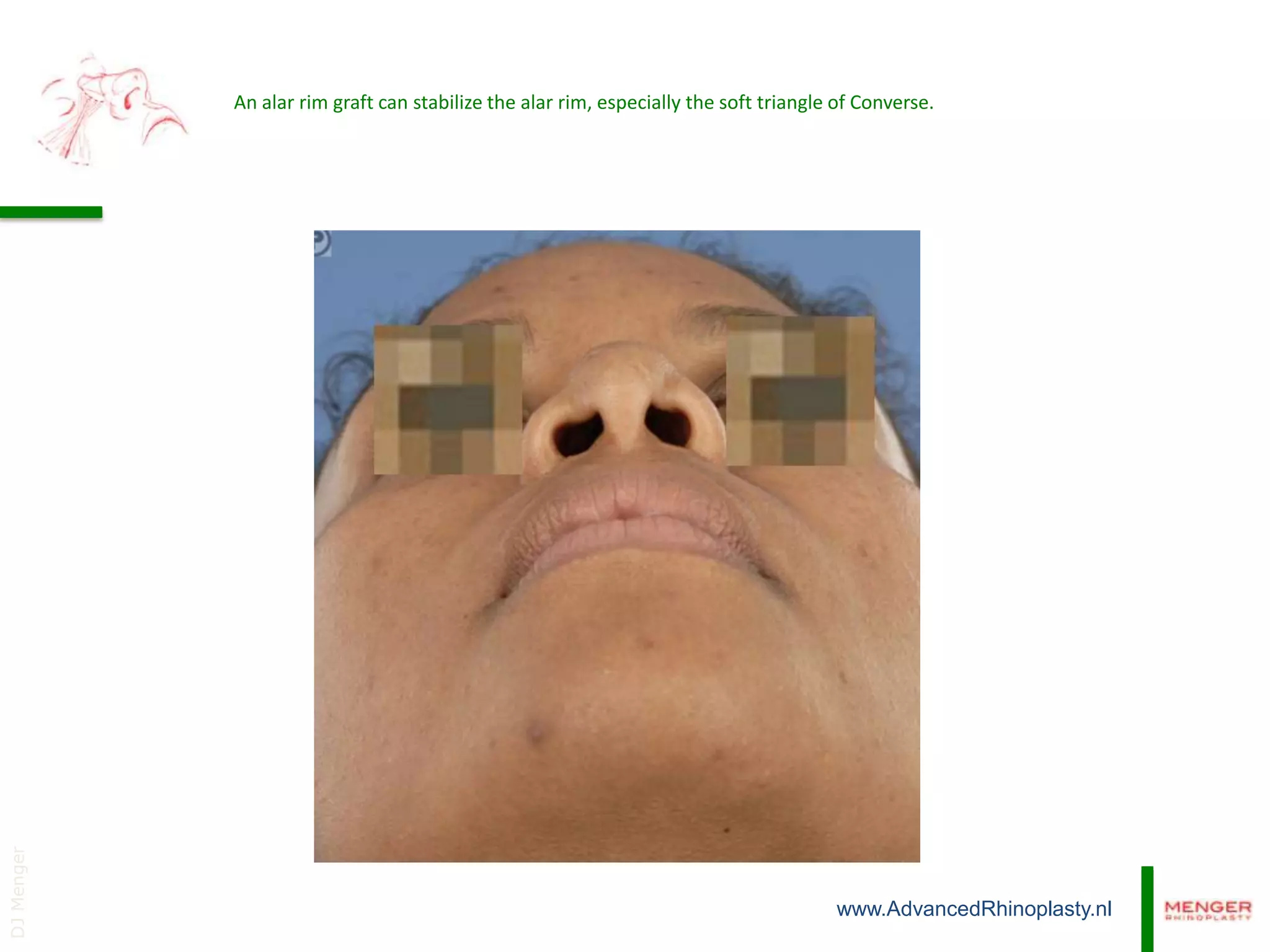 Grafts in Nasal Surgery - Advanced Rhinoplasty | PPTX