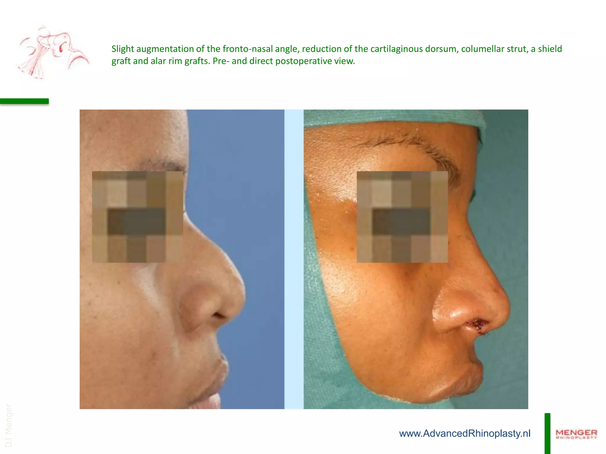 Grafts in Nasal Surgery - Advanced Rhinoplasty | PPTX