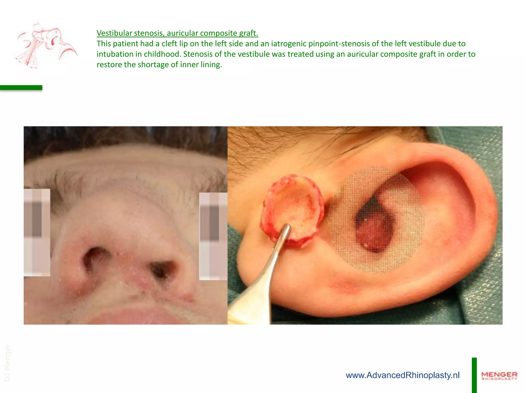 Grafts in Nasal Surgery - Advanced Rhinoplasty | PPTX