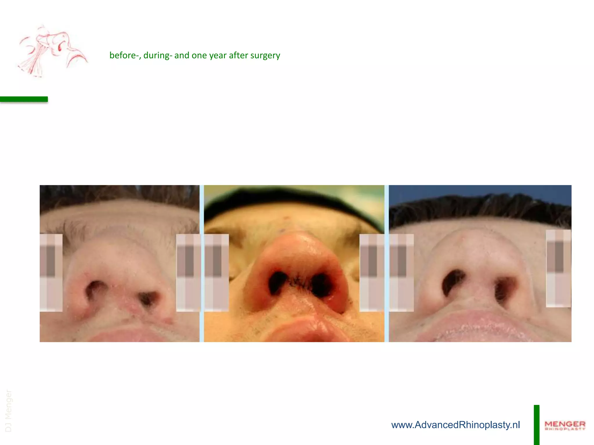 Grafts in Nasal Surgery - Advanced Rhinoplasty | PPTX