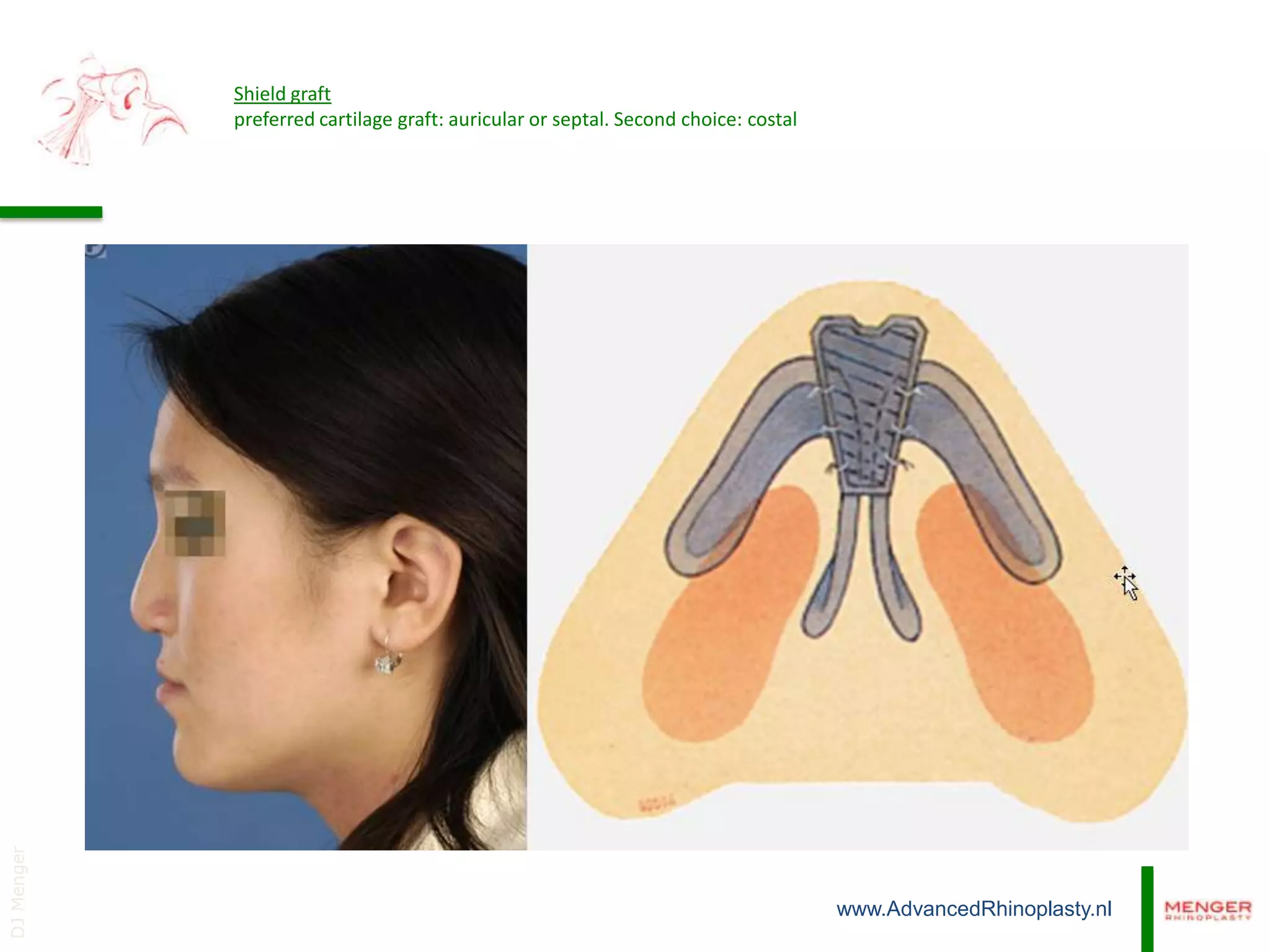 Grafts in Nasal Surgery - Advanced Rhinoplasty | PPTX