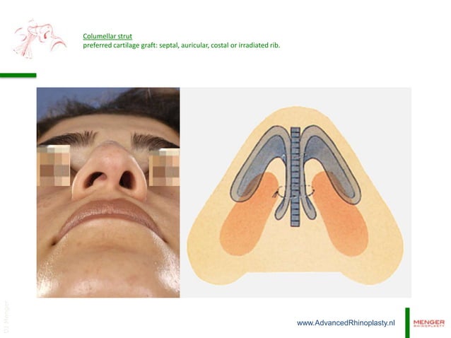 Grafts in Nasal Surgery - Advanced Rhinoplasty | PPTX