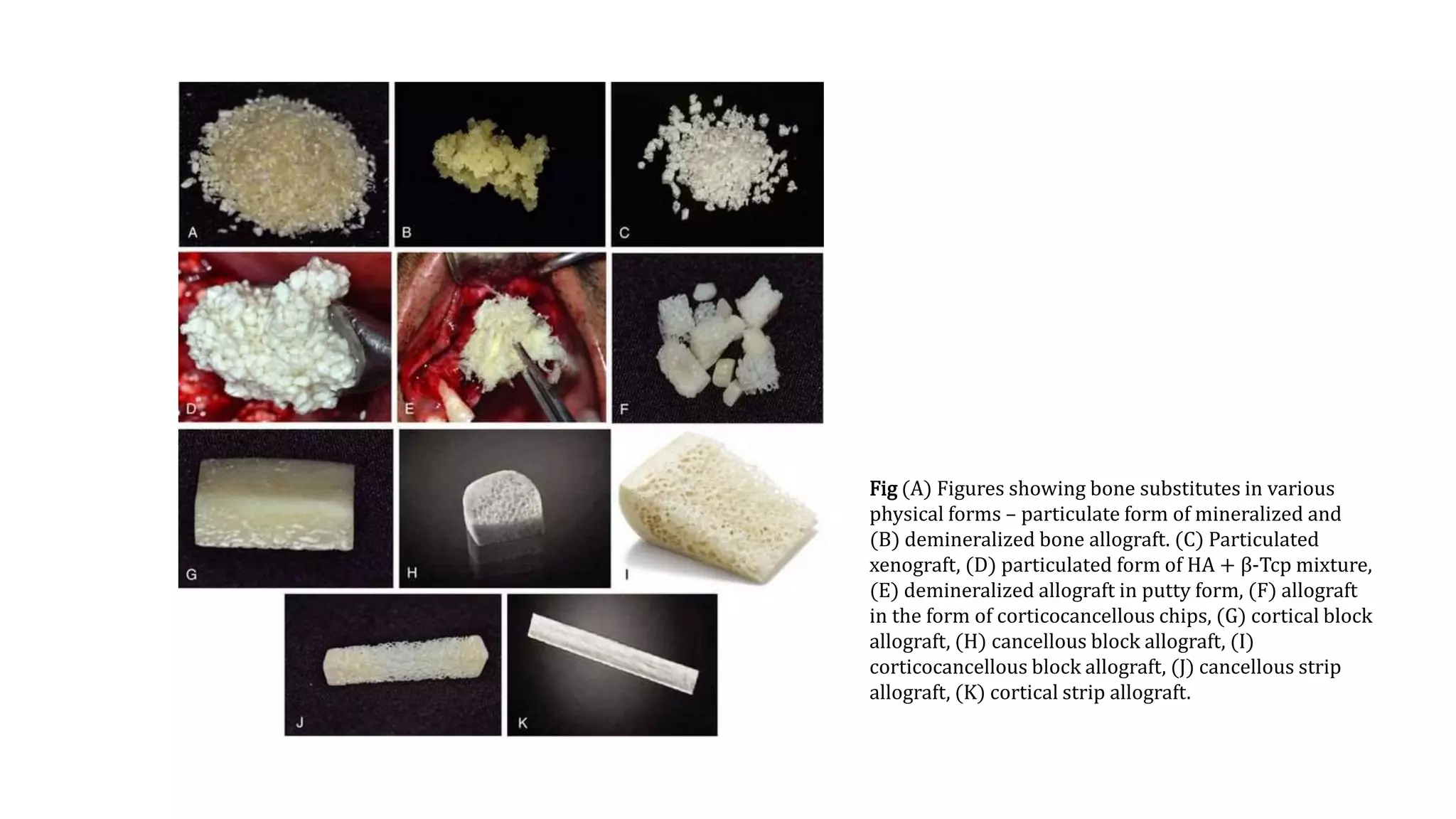 Grafts in oral and maxillofacial surgery | PPTX