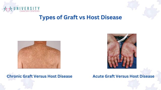 Graft Vs Host Disease Ppt