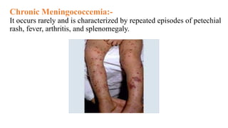 All Paramedical, Nursing and MBBS Courses/GRAM NEGATIVE COCCI.pptx ...