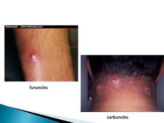 Gram positive infections | PPTX