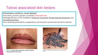 Tatoo associated skin lesions, presenting a case with skin sarcoidosis ...