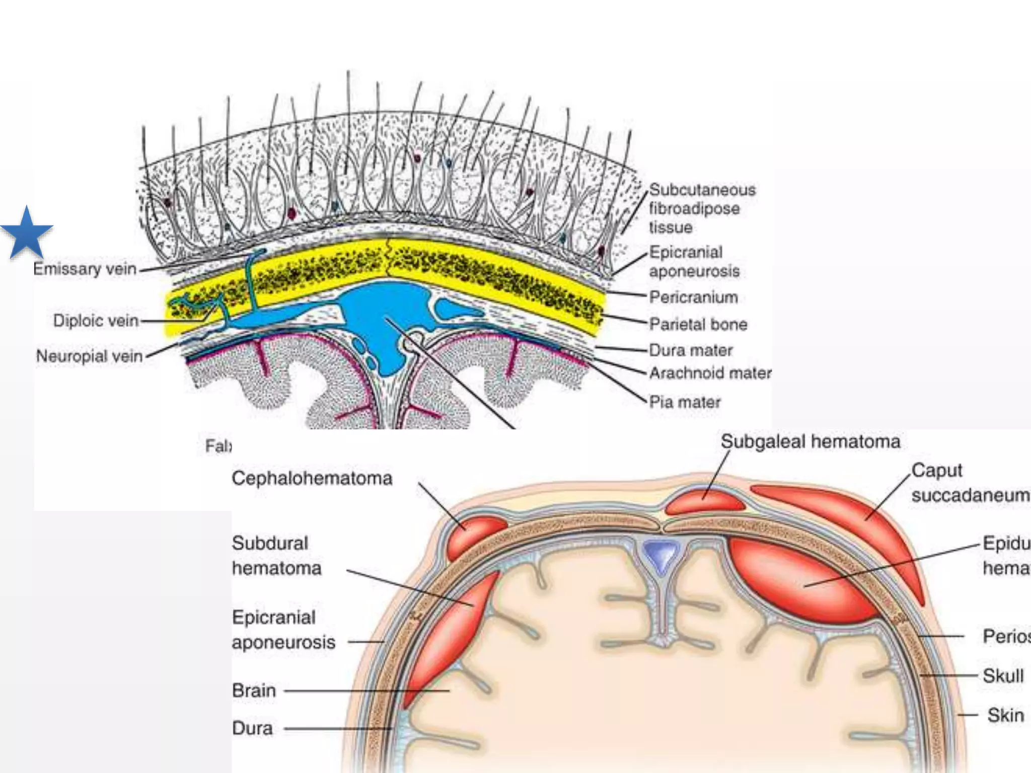Hematoma subgaleal | PPTX