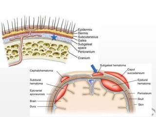 Hematoma subgaleal | PPT