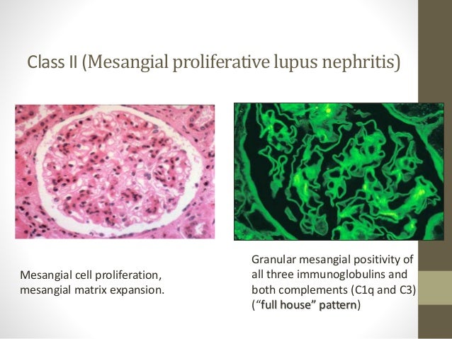 Grand round- SLE- LUPUS NEPHRITIS