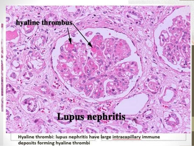 Grand round- SLE- LUPUS NEPHRITIS