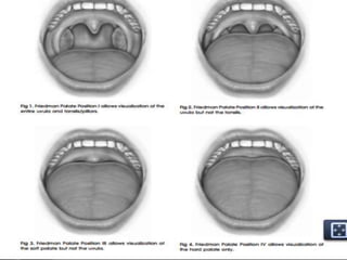 Grand round obstructive sleep apnea in adults | PPTX