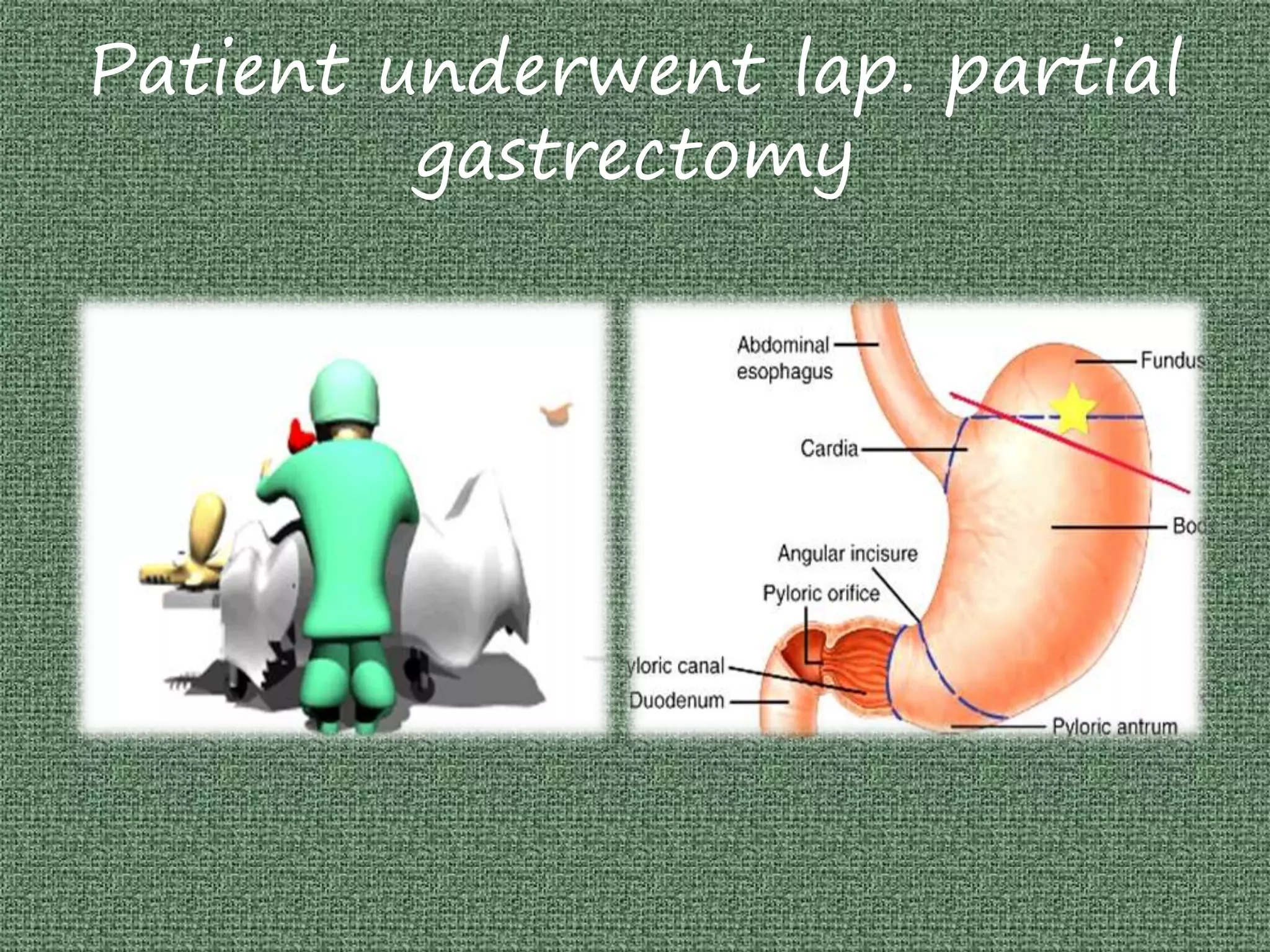 Grand round presentation on Dieulafoy's lesions | PPTX