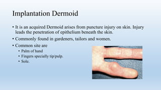 Granthi (cyst) | PPTX