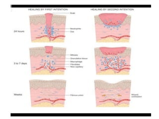 GRANULATION TISSUE.pptx