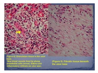 Granulation Tissue Histology