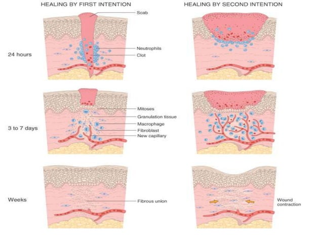 Granulation tissue formation | PPTX