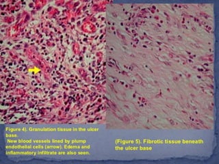Granulation tissue formation | PPTX
