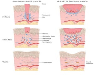 Granulation tissue formation | PPT