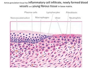 Granulation Tissue Histology
