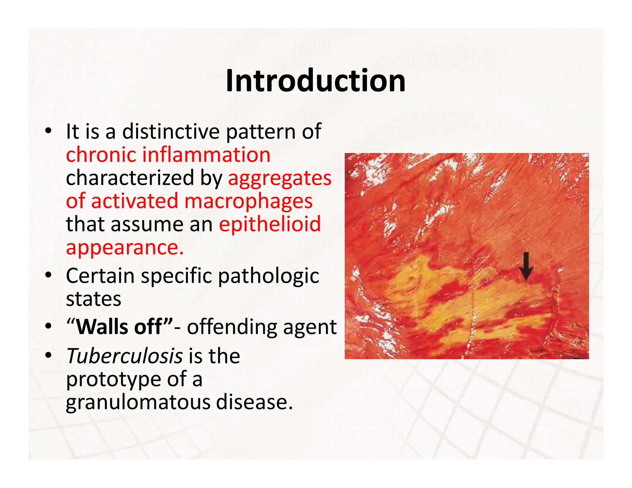 granuloma inflammation powerpoint presentation | PPTX